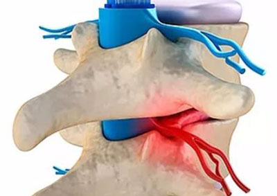 Fibromyalgia | Chiropractor Torrance | Back to Healthcare Chiropractic