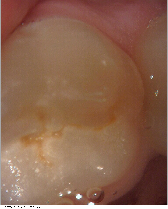 Fluoride Bomb | Image Dental