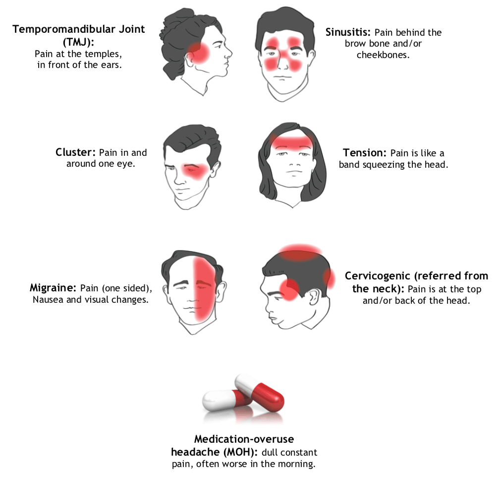 Types Headaches Diagram Types Headaches Diagram