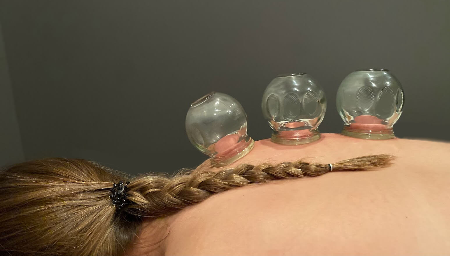 Acupuncture and Cupping Farmington MN | Family Chiropractic Center