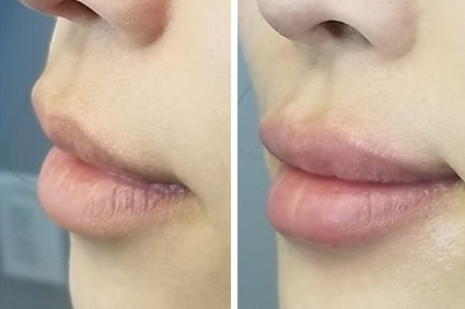Botox Lips Before After | Lipstutorial.org