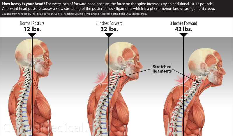 Forward Head Posture Can Create Problems Such As Headaches Neck Discomfort Pinched Nerves Of 