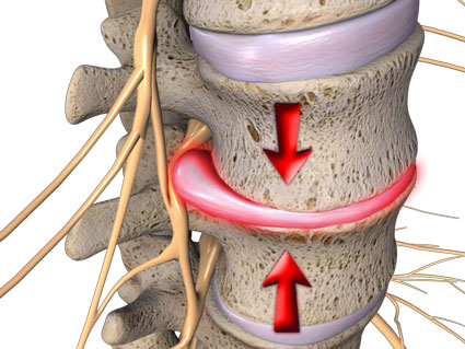 Spinal Decompression | Wellness Revolution