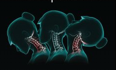 Whiplash : Neck Pain Series Part IV | Kinesis Health Associates